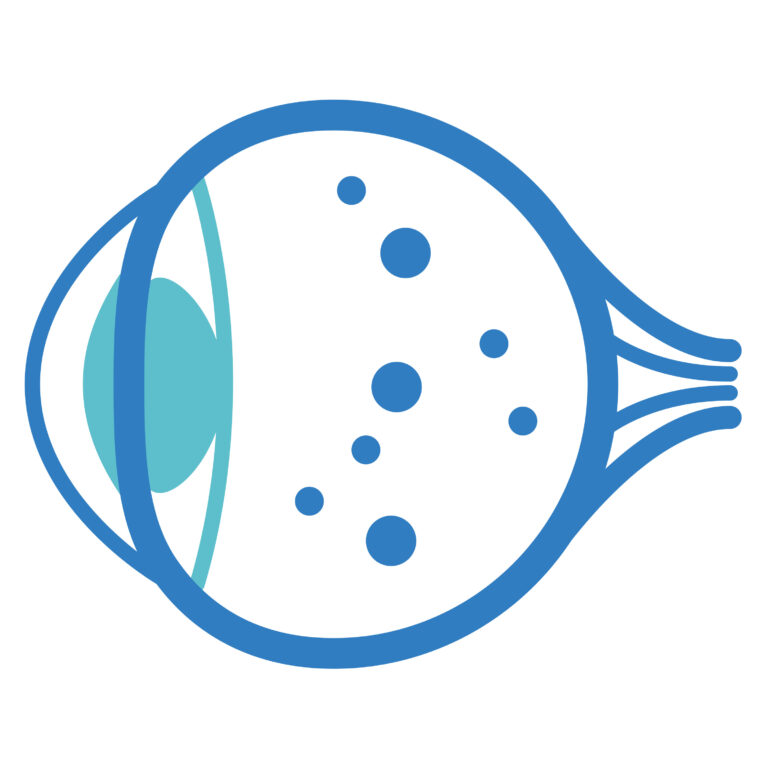 Moscas Flotantes Visuales (Miodesopsias)