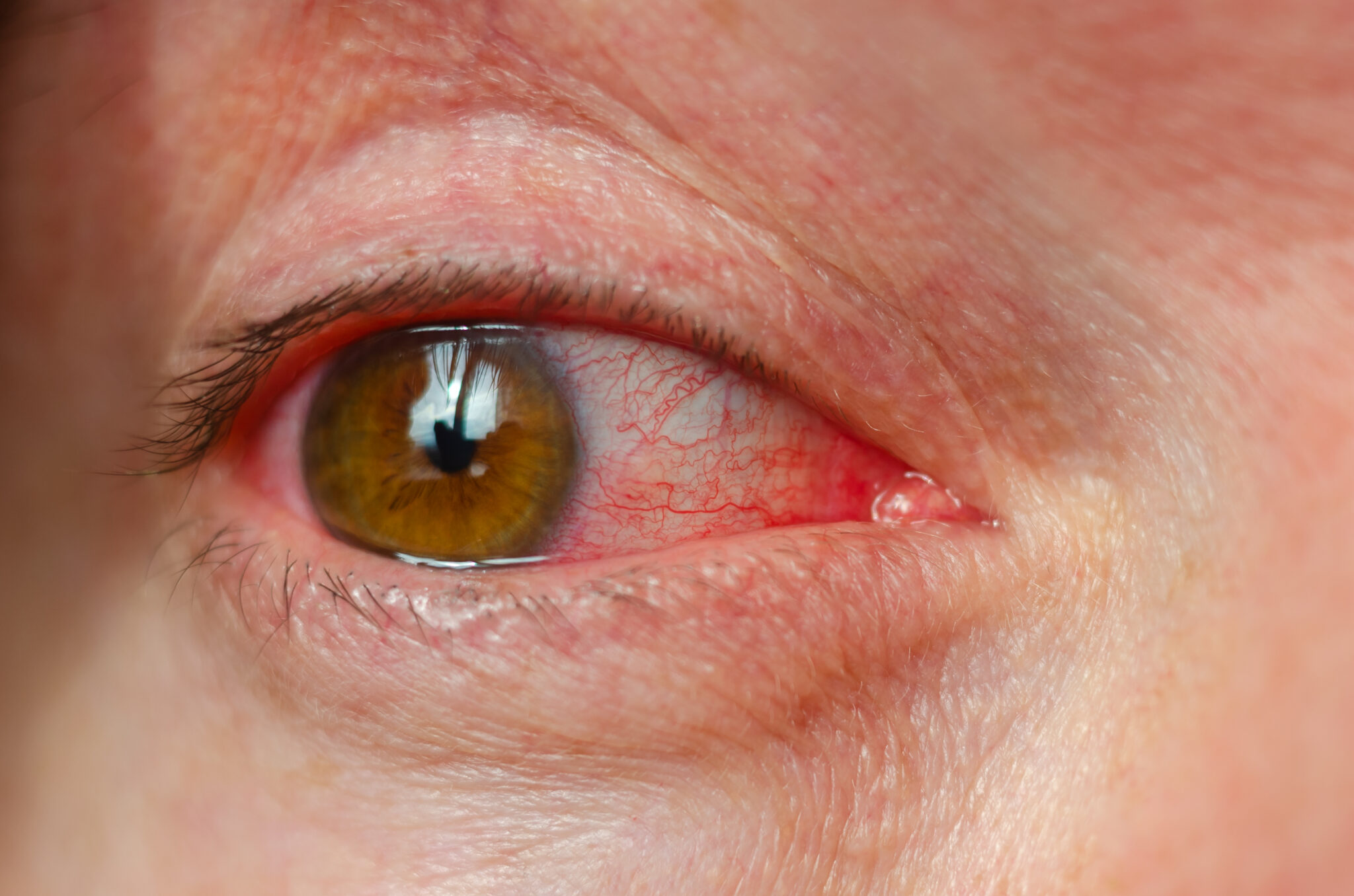 Derrame ocular y opciones de tratamiento.
