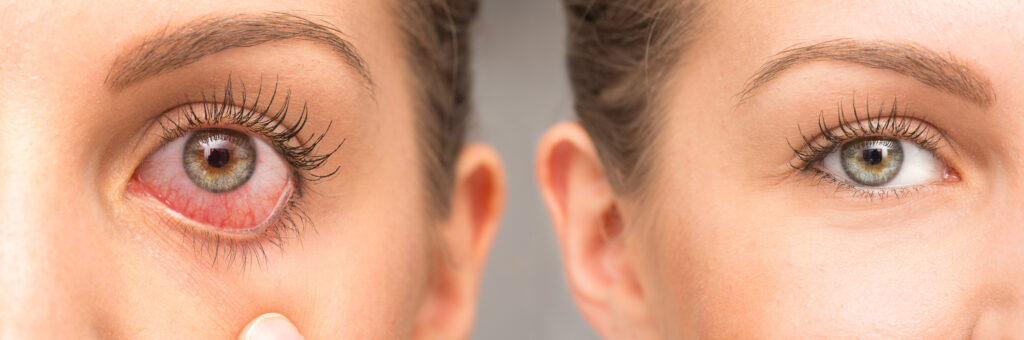 los ojos rojos ¿cuales son sus causas?